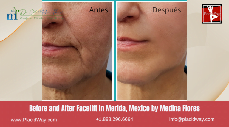 Facelift in Merida Mexico - Cost, Clinics & FAQs