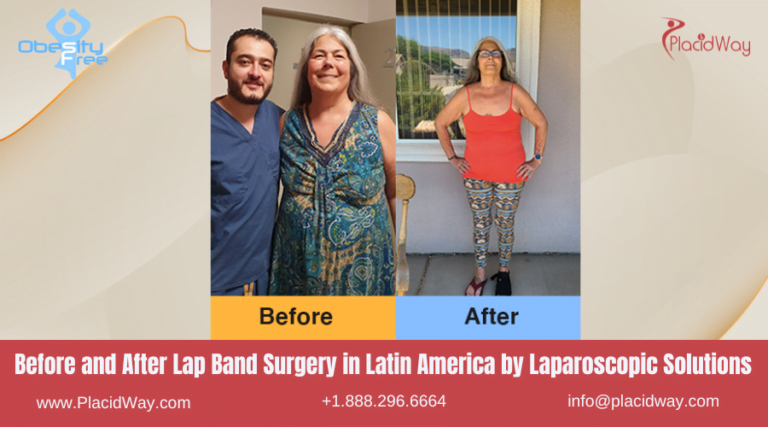 Lap Band Surgery in Latin America - Top Clinics & Cost