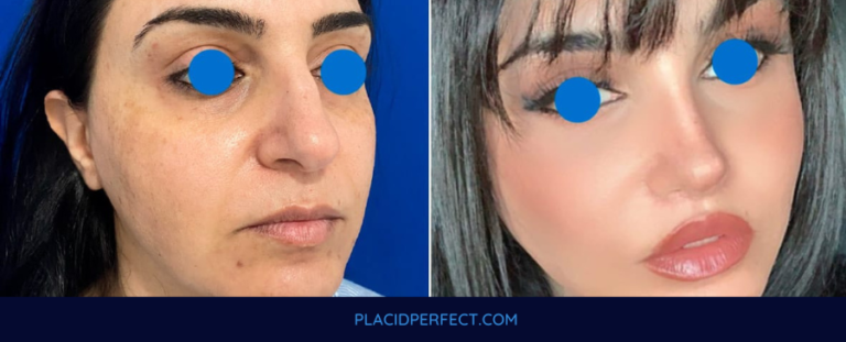 Facelift Surgery in Mexico - Restore your younger look